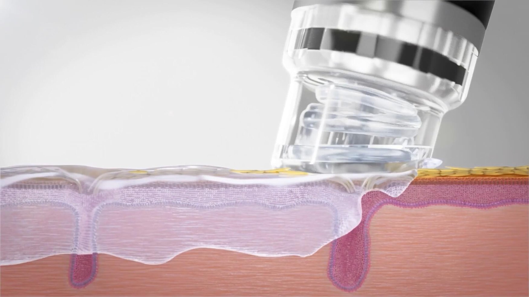 Hydrafacial - Customized treatment for all skin types and concerns